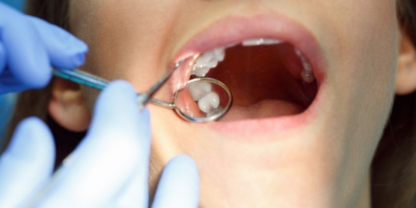 ¿Cuándo se realiza la extracción de una muela? - Consultorio Implantes ...